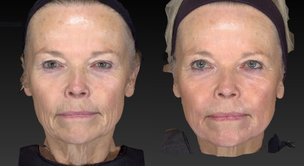 Pearl® Fractional Laser for Deep Wrinkles | Clinic 805